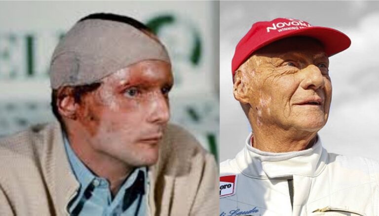 Niki Lauda Crash: The Tragic Accident That Defined a Legend
